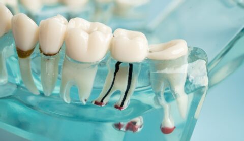 Is a Root Canal Worth It? The Pros and Cons - Affordable Dentists