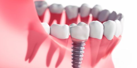 Tooth Replacement - Affordable Dentists